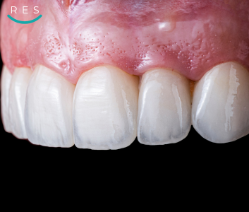 DENTAL FISTULA: A Warning Sign You Should Never Ignore - RES Dental